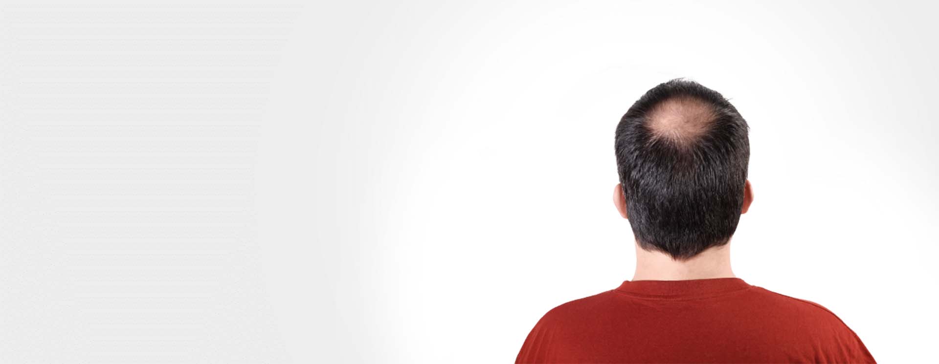 Real Results - Vertex Hair Transplant